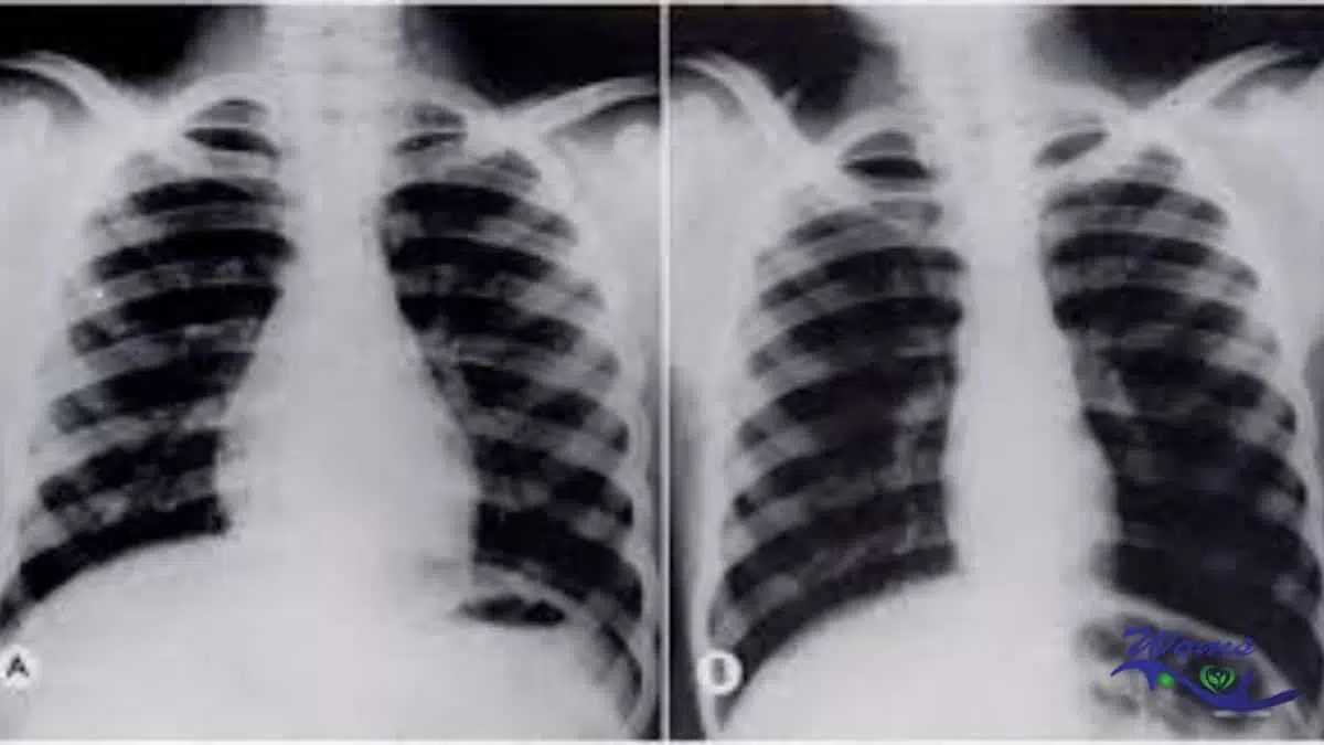 Small heart: Is it fatal? - Make My Health Well